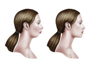 ¿Qué es la retrognatia mandibular?